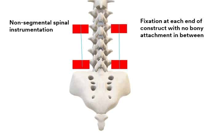 Posterior instrumentation for spinal fusion - 3M Inside Angle