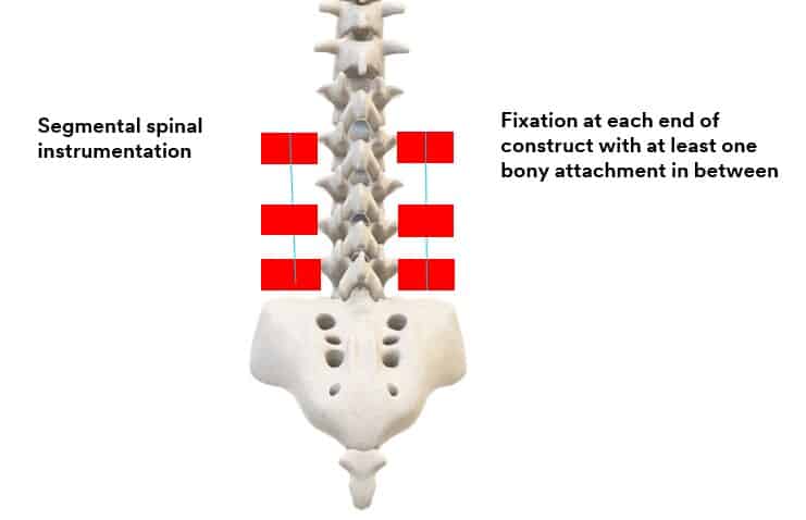 Posterior instrumentation for spinal fusion - 3M Inside Angle